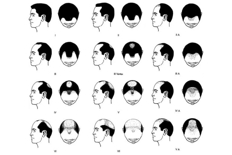 Norwood scale - Meditravel.com